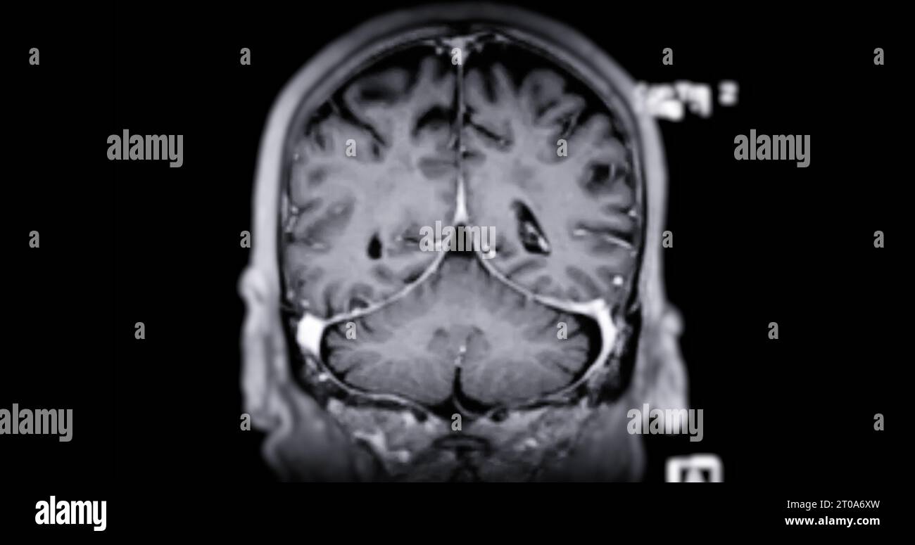 MRI scan of the brain for detect Brain diseases sush as stroke disease ...