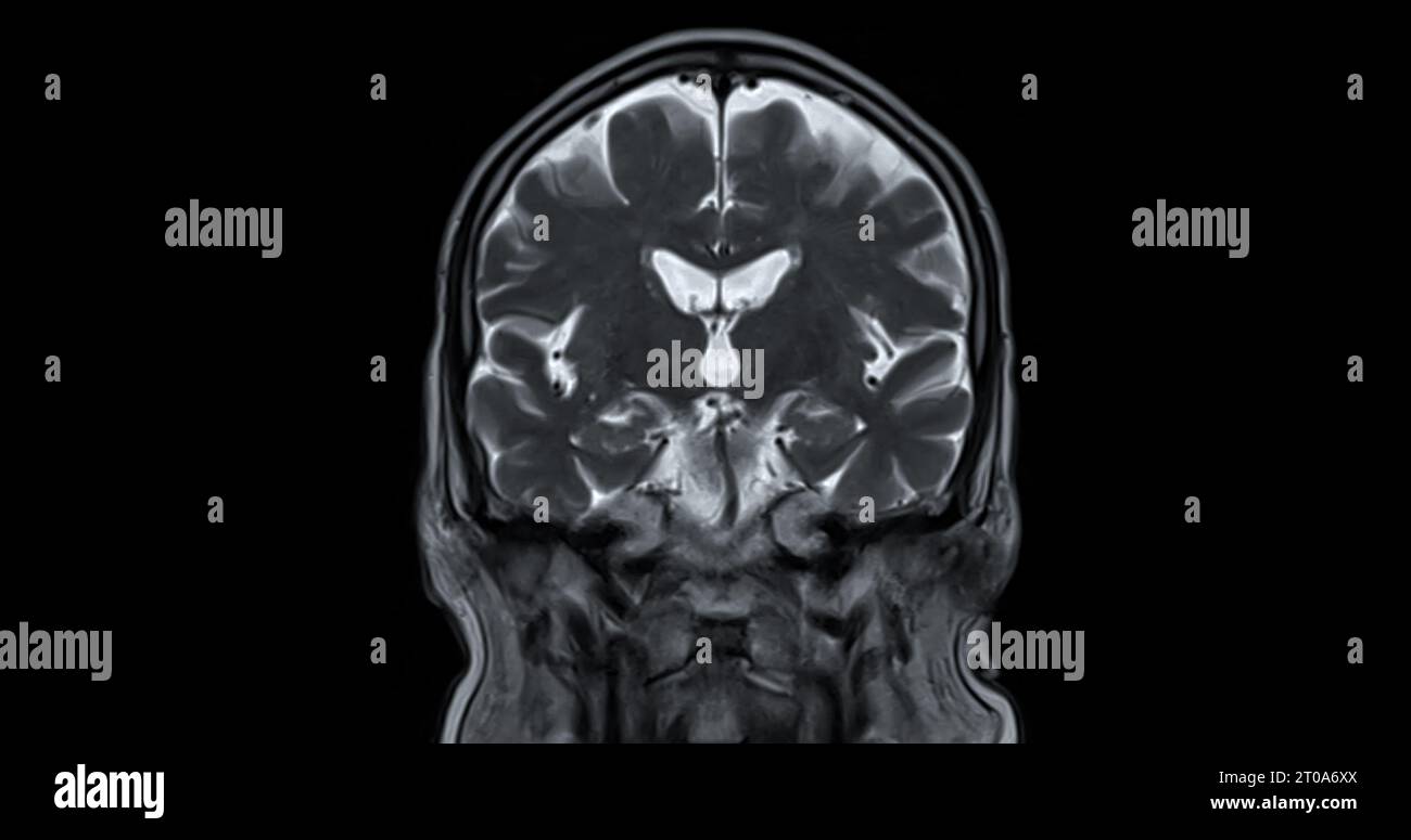 MRI scan of the brain for detect Brain diseases sush as stroke disease ...