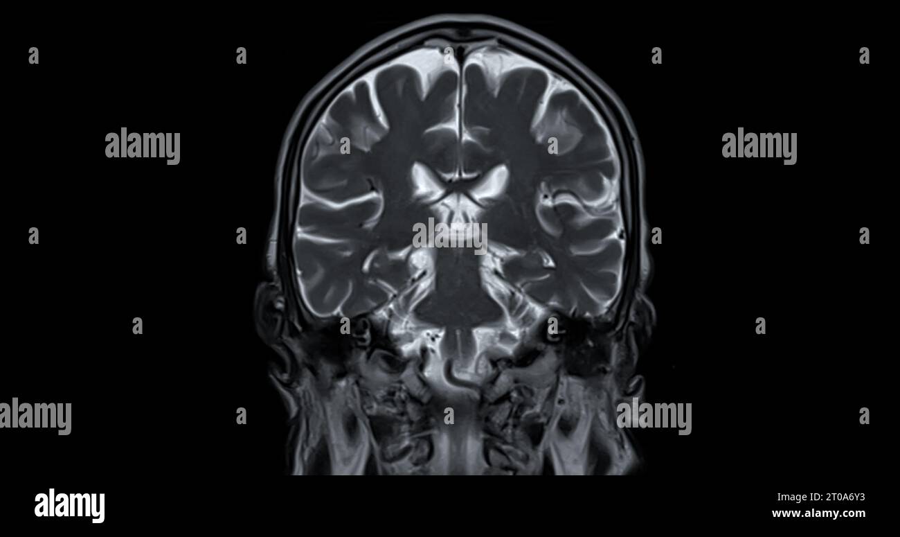 MRI scan of the brain for detect Brain diseases sush as stroke disease ...