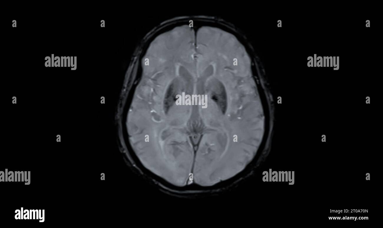 MRI scan of the brain for detect Brain diseases sush as stroke disease ...