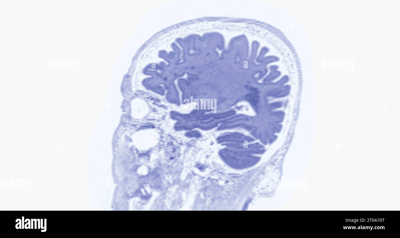 MRI scan of the brain for detect Brain diseases sush as stroke disease ...