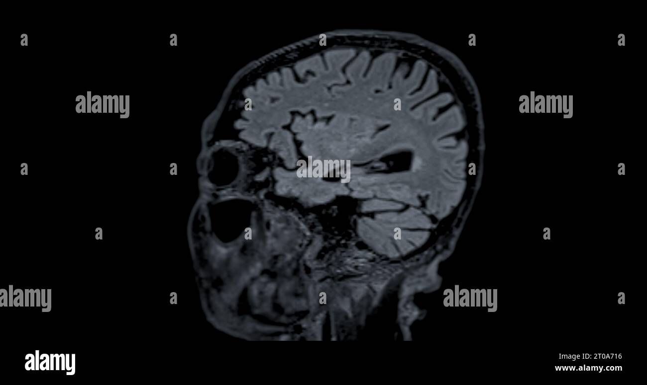 MRI scan of the brain for detect Brain diseases sush as stroke disease ...