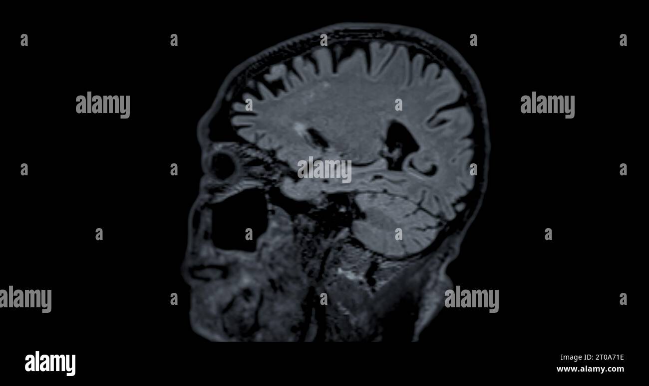 MRI scan of the brain for detect Brain diseases sush as stroke disease ...