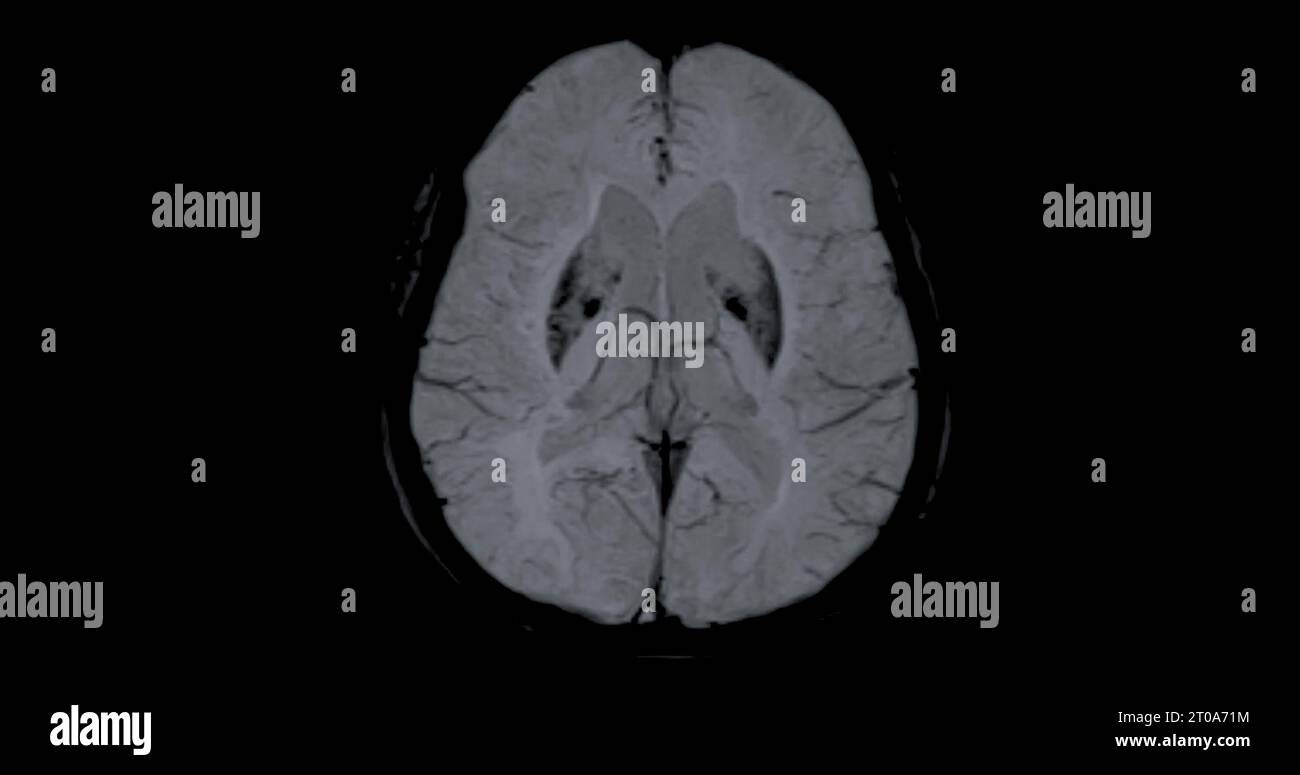 MRI scan of the brain for detect Brain diseases sush as stroke disease ...