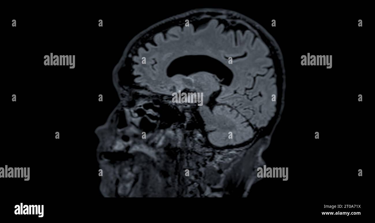 MRI scan of the brain for detect Brain diseases sush as stroke disease ...