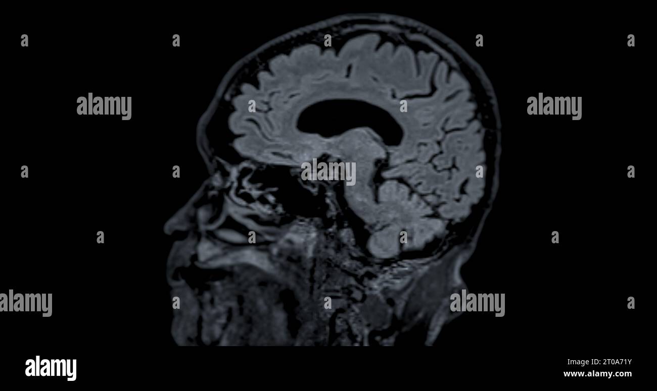 MRI scan of the brain for detect Brain diseases sush as stroke disease ...