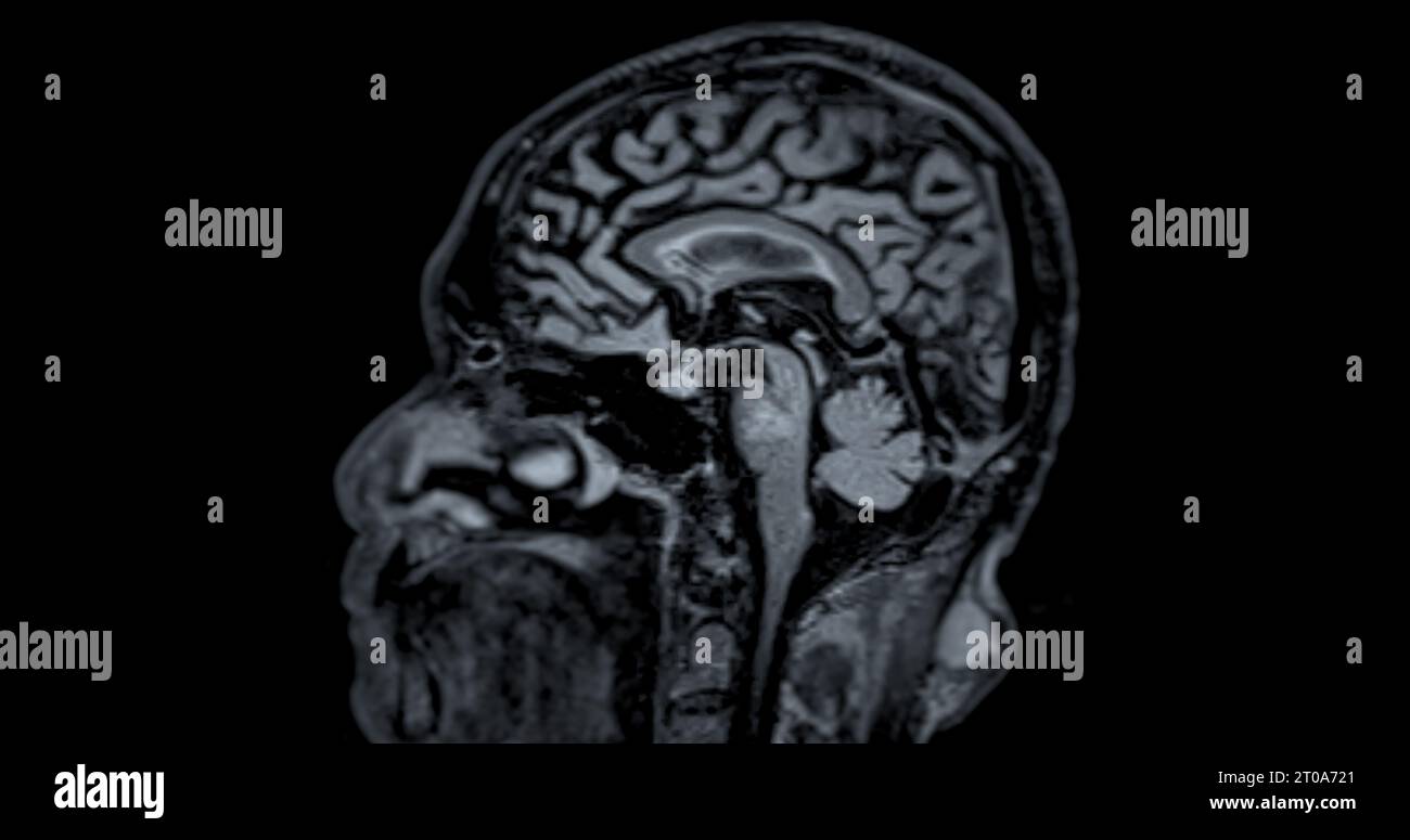 MRI scan of the brain for detect Brain diseases sush as stroke disease ...