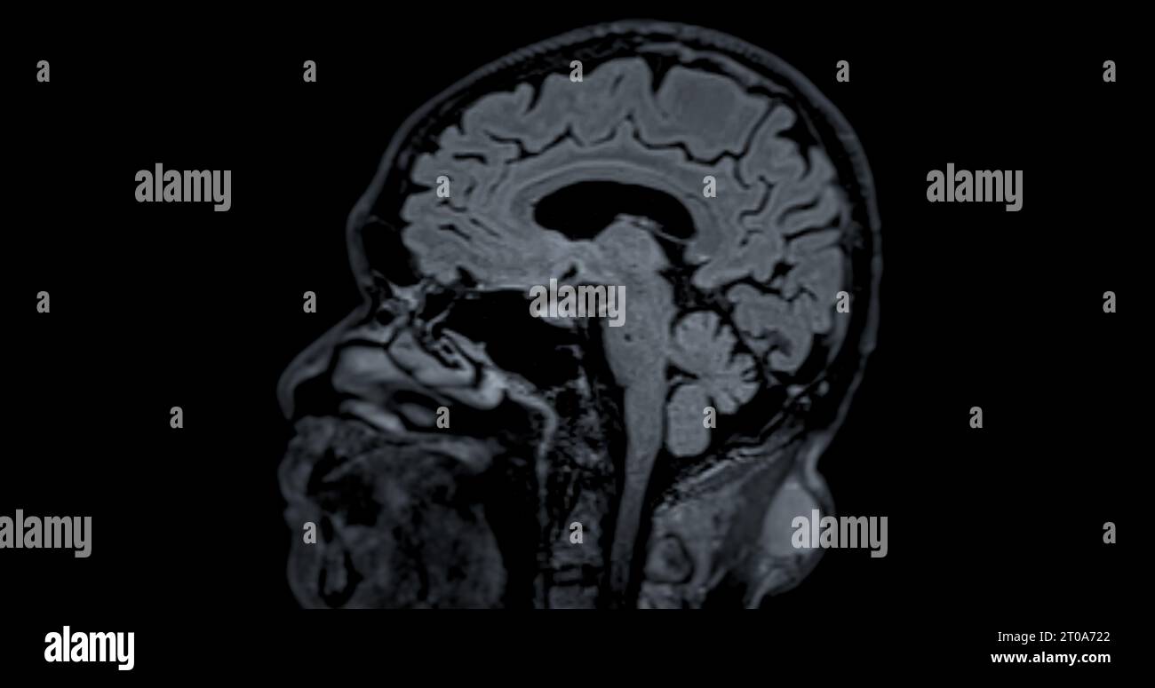 MRI scan of the brain for detect Brain diseases sush as stroke disease ...