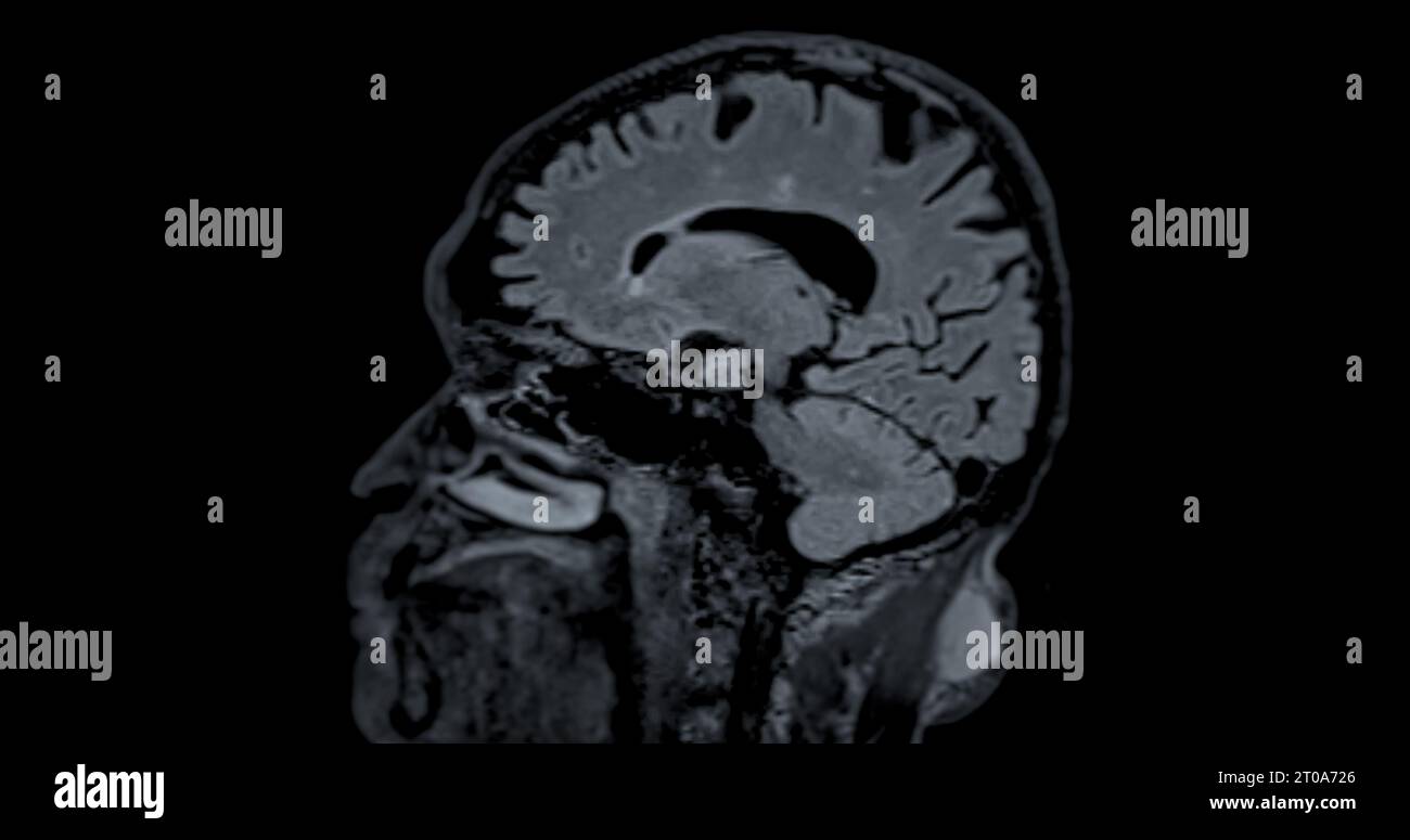 MRI scan of the brain for detect Brain diseases sush as stroke disease ...