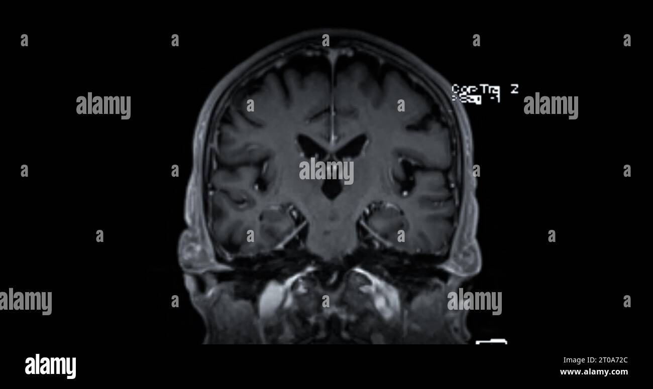 MRI scan of the brain for detect Brain diseases sush as stroke disease ...