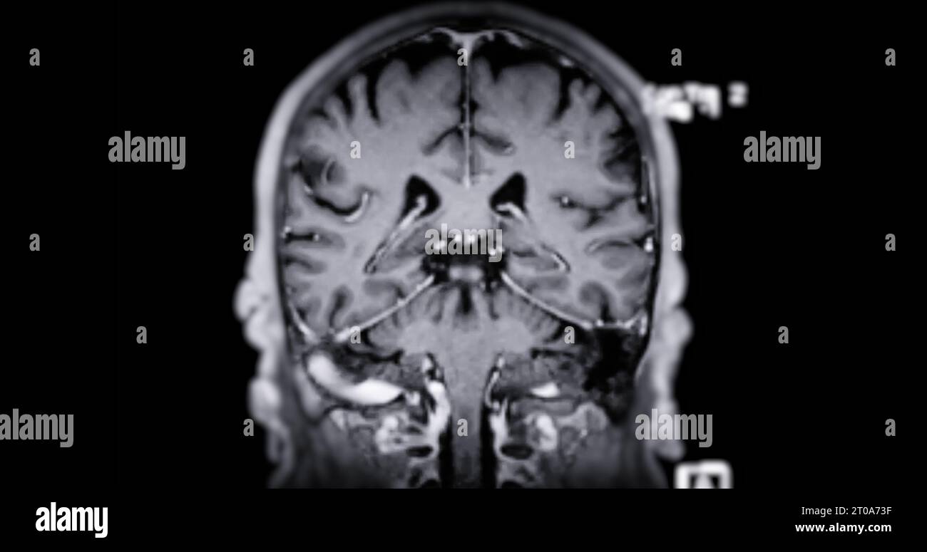 MRI scan of the brain for detect Brain diseases sush as stroke disease ...