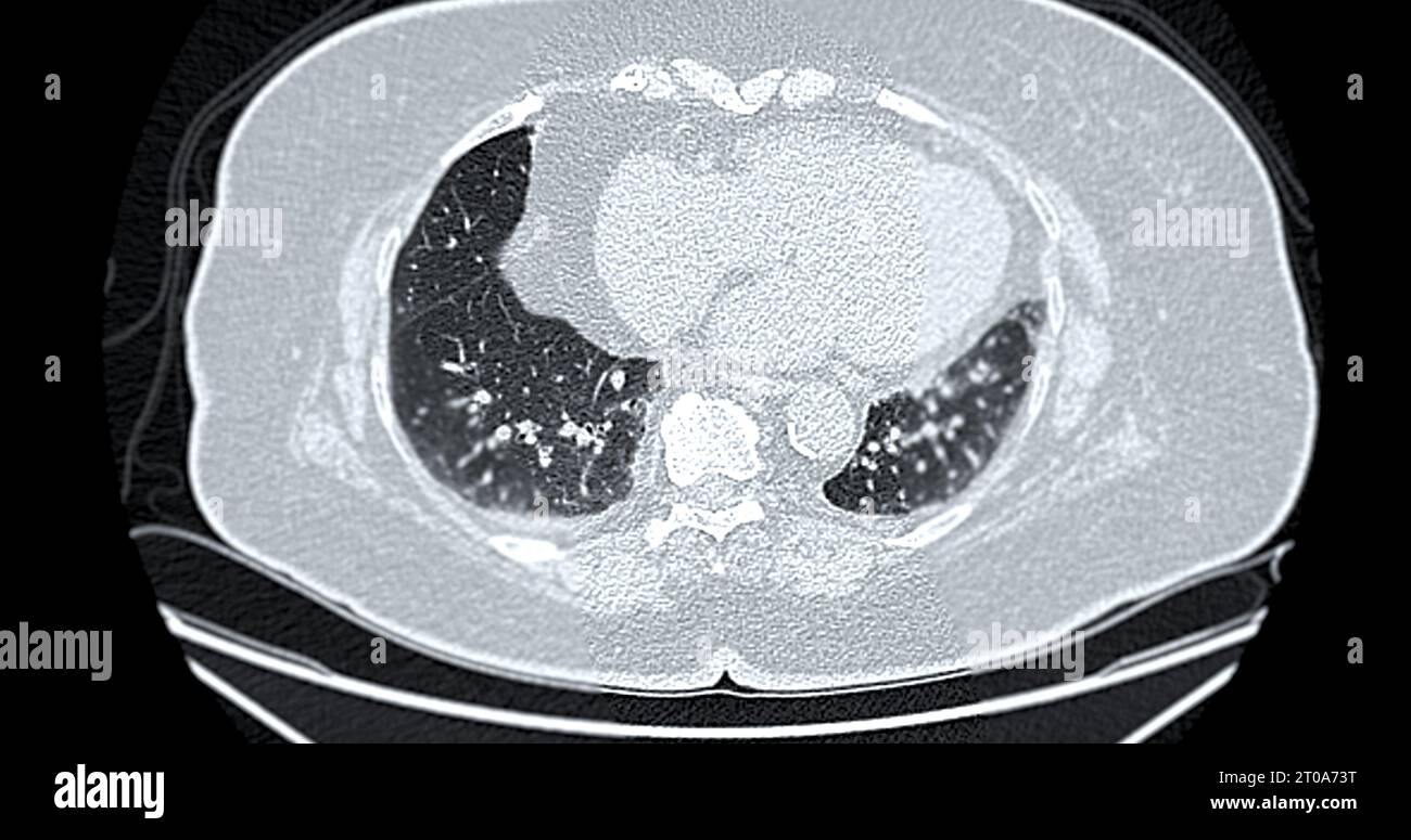 CT scan of Chest axial view for diagnostic Pulmonary embolism (PE ...