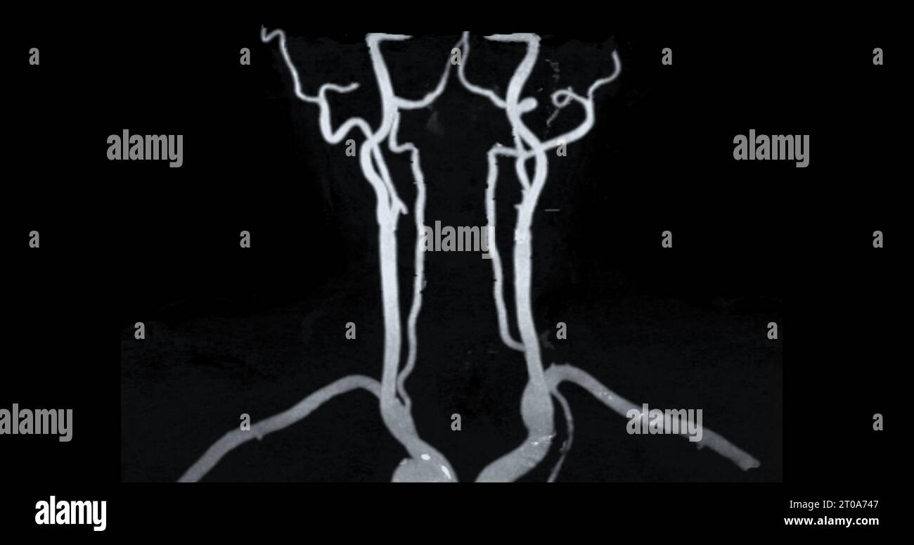 Ct angiography brain medical hi-res stock photography and images - Alamy