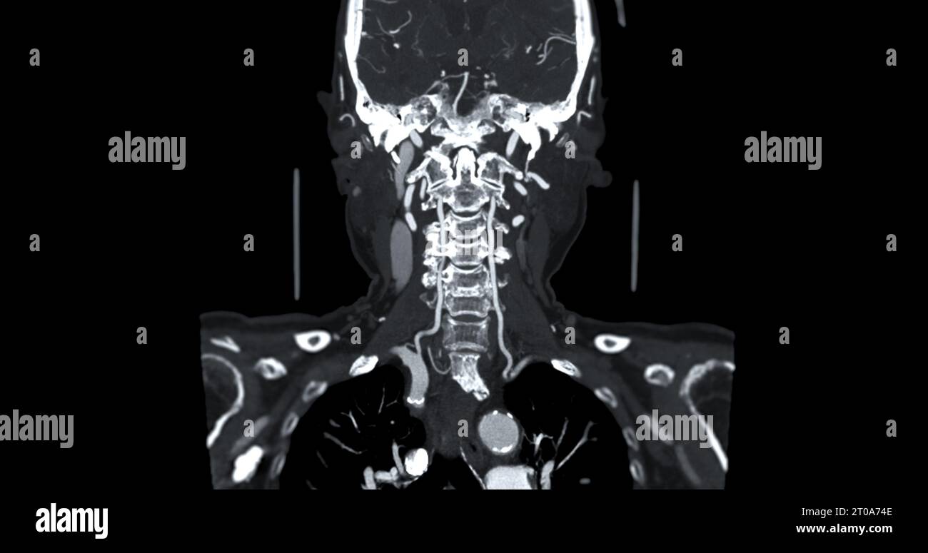 CT angiography of the brain . medical technology concept Stock Photo ...