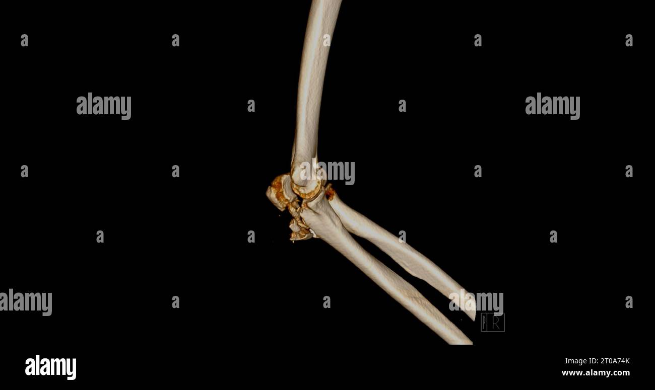 CT scan of elbow joint 3d rendering Stock Photo - Alamy