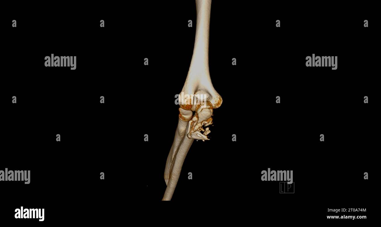 Elbow flexion and extension hi-res stock photography and images - Alamy