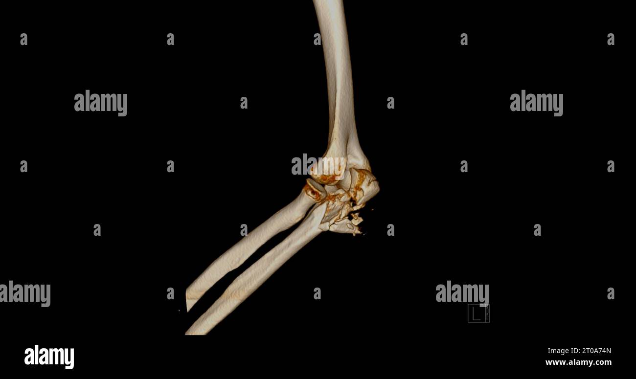 CT scan of elbow joint 3d rendering Stock Photo - Alamy