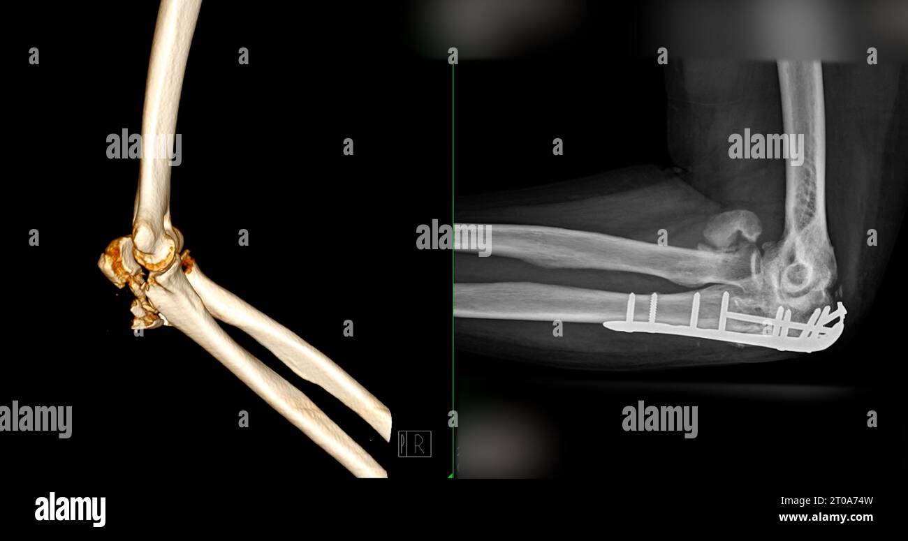 CT scan of elbow joint 3d rendering Stock Photo - Alamy CT scan of elbow joint 3d rendering Stock Photo - Alamy