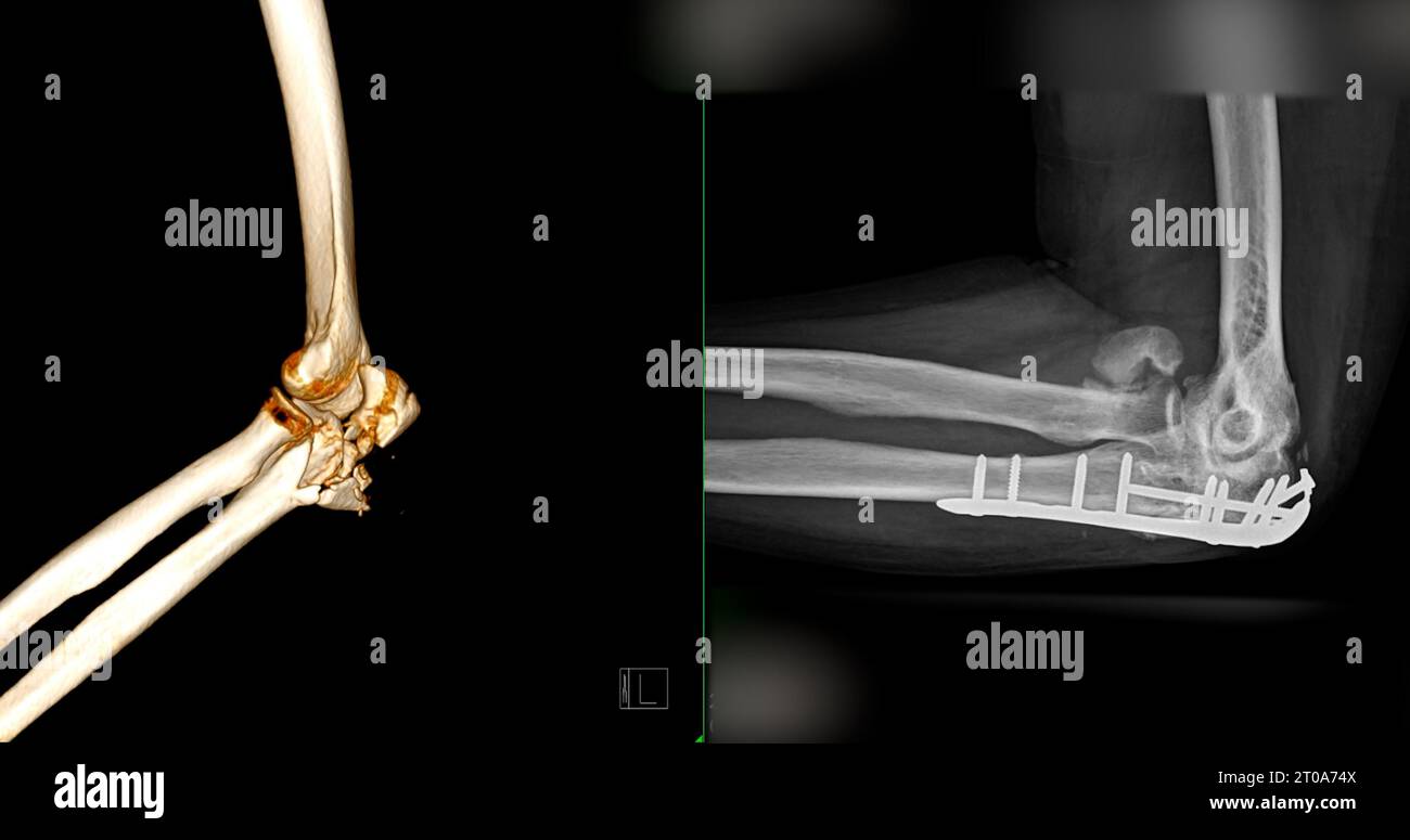 Ct scan elbow joint hi-res stock photography and images - Alamy