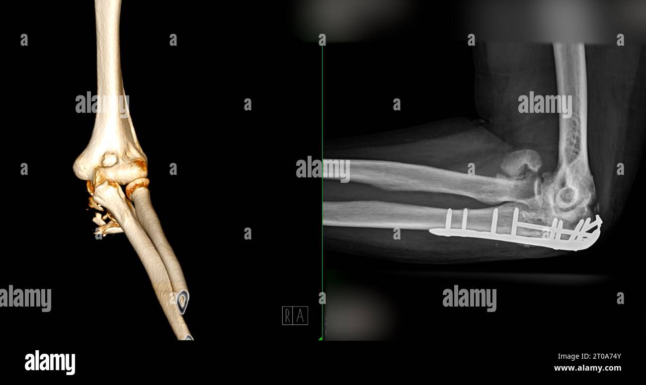 Elbow flexion and extension hi-res stock photography and images - Alamy