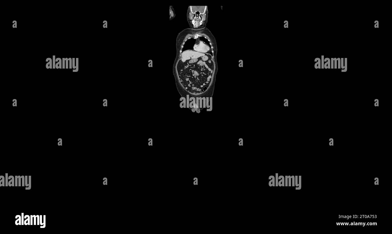 CT Scan of whole body with injection contrast media coronal view for ...