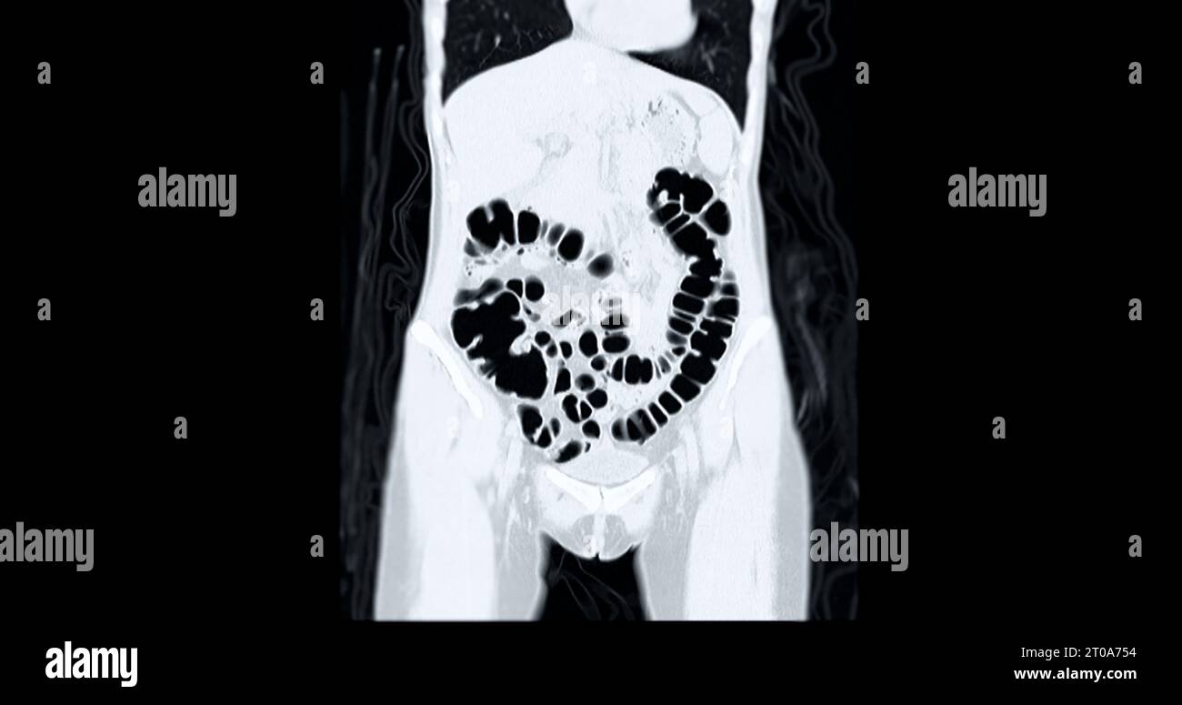 Colonoscopy hi-res stock photography and images - Alamy
