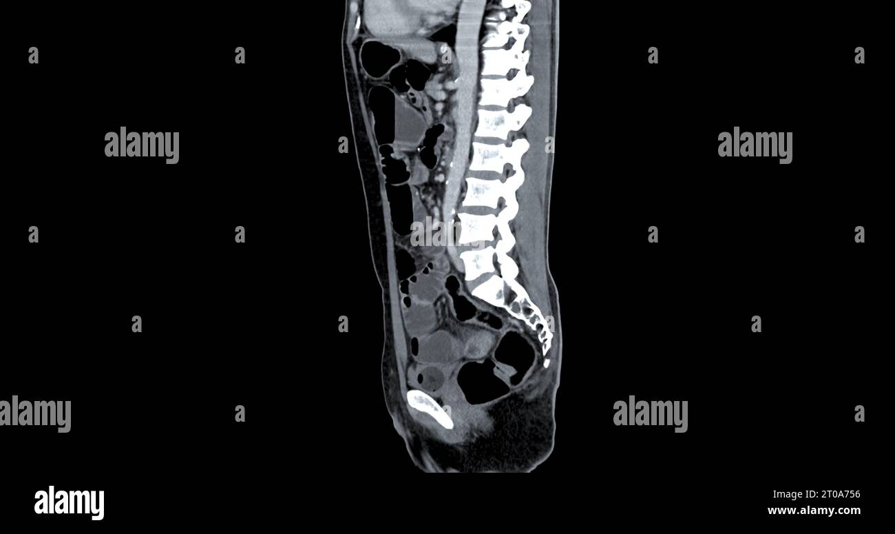 CT Chest and Abdomen with injection contrast media coronal view for ...