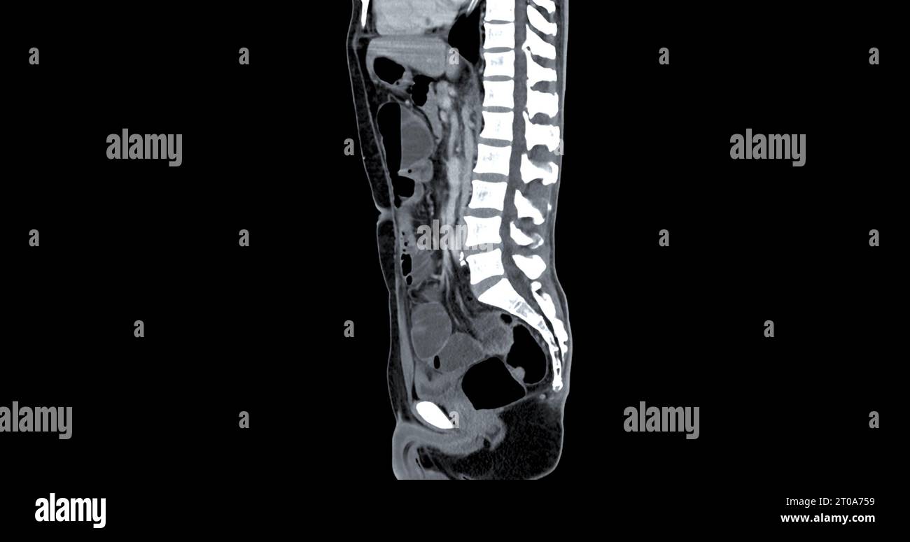 Sagittal Ct Abdomen Labeled