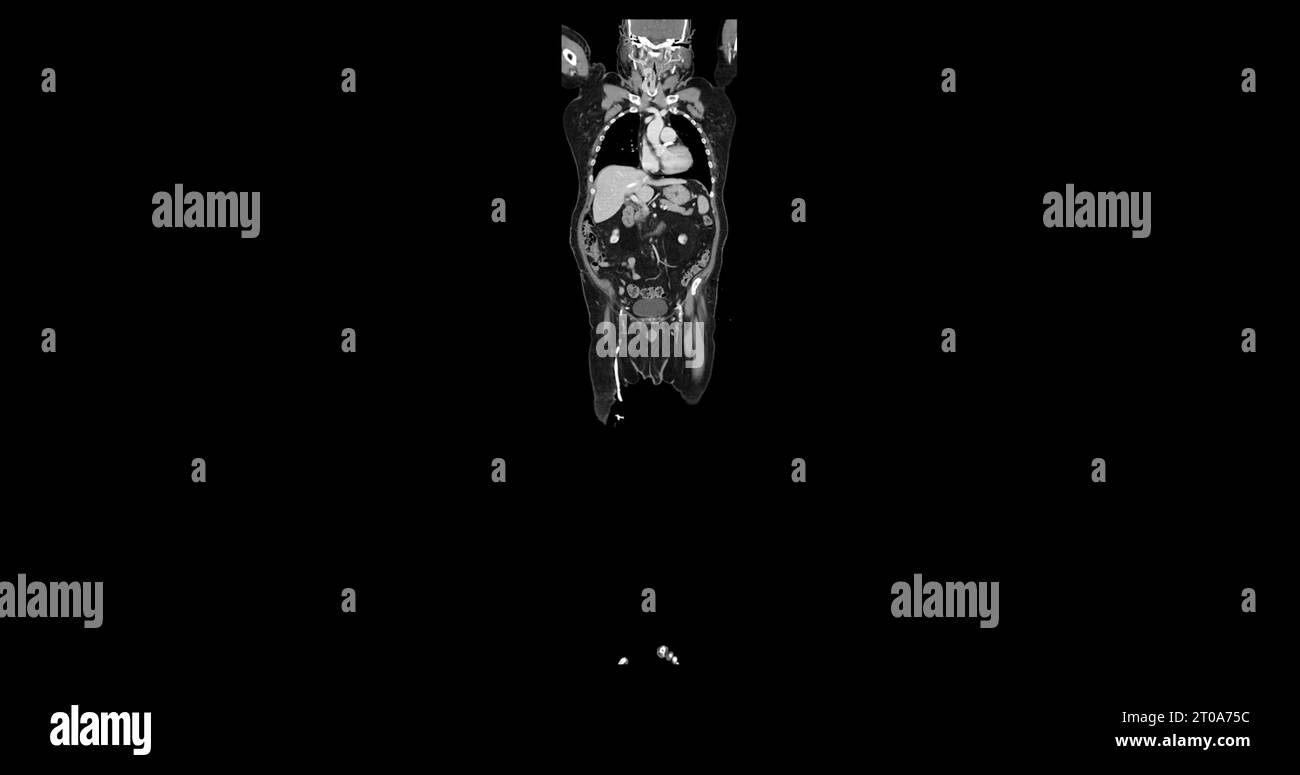 CT Scan of whole body with injection contrast media coronal view for ...