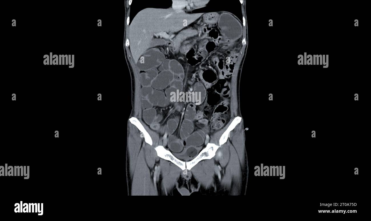 CT Chest and Abdomen with injection contrast media coronal view for ...