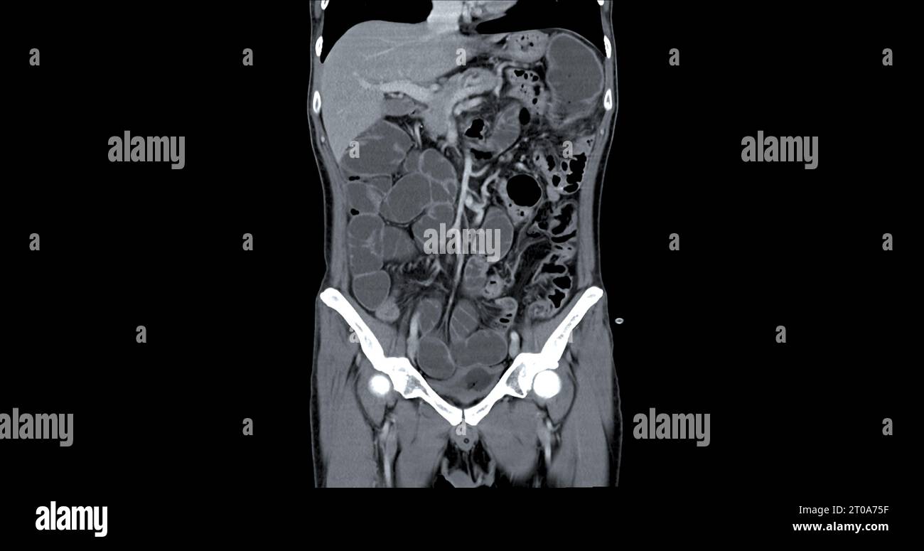 CT Chest and Abdomen with injection contrast media coronal view for ... CT Chest and Abdomen with injection contrast media coronal view for ...