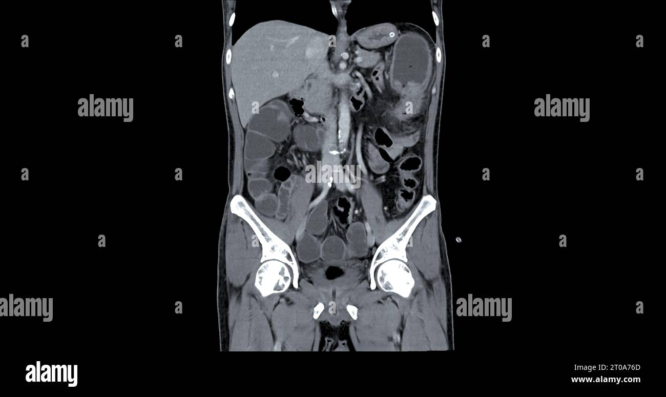 CT Chest and Abdomen with injection contrast media coronal view for ...