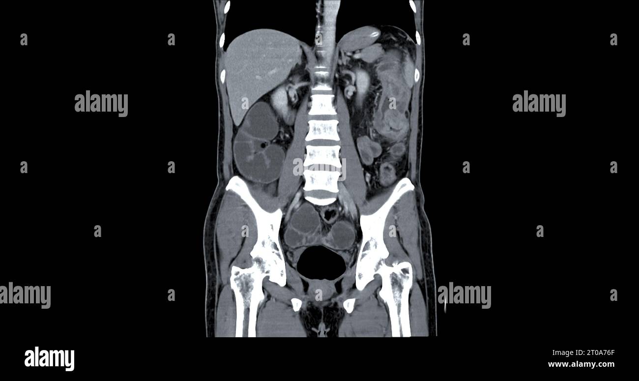 CT Chest and Abdomen with injection contrast media coronal view for ...