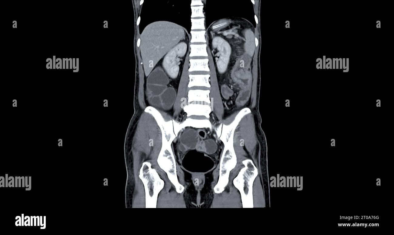 CT Chest and Abdomen with injection contrast media coronal view for ... CT Chest and Abdomen with injection contrast media coronal view for ...