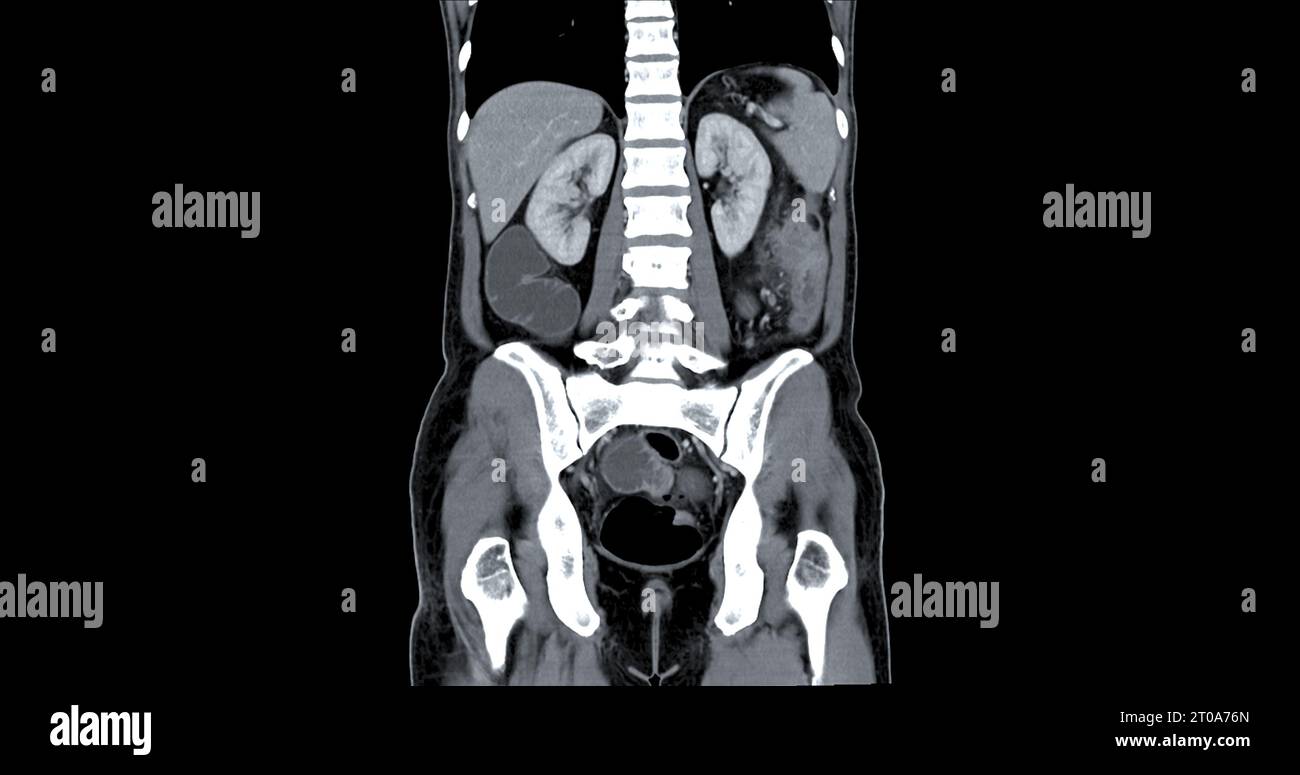 CT Chest and Abdomen with injection contrast media coronal view for ...