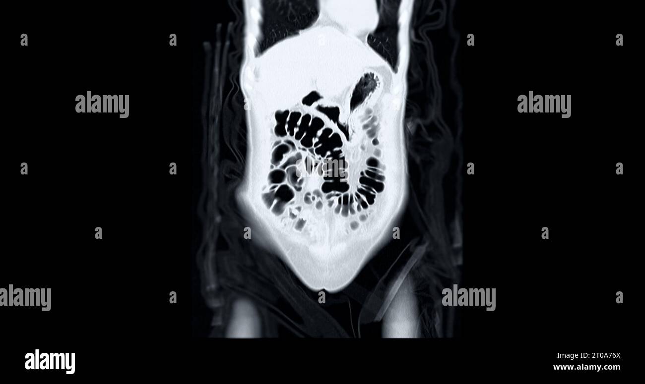 CT Colonoscopy coronal view .Medical background Stock Photo - Alamy