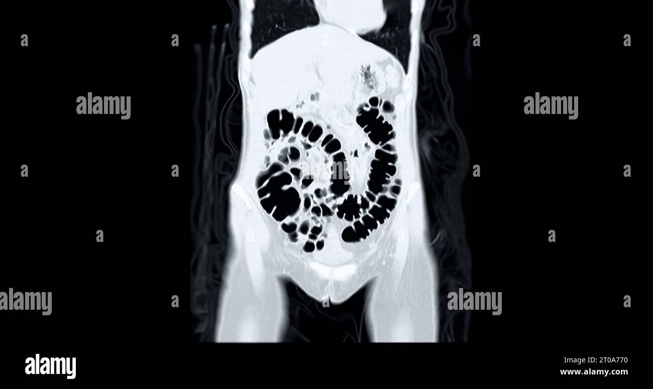 CT Colonoscopy coronal view .Medical background Stock Photo - Alamy