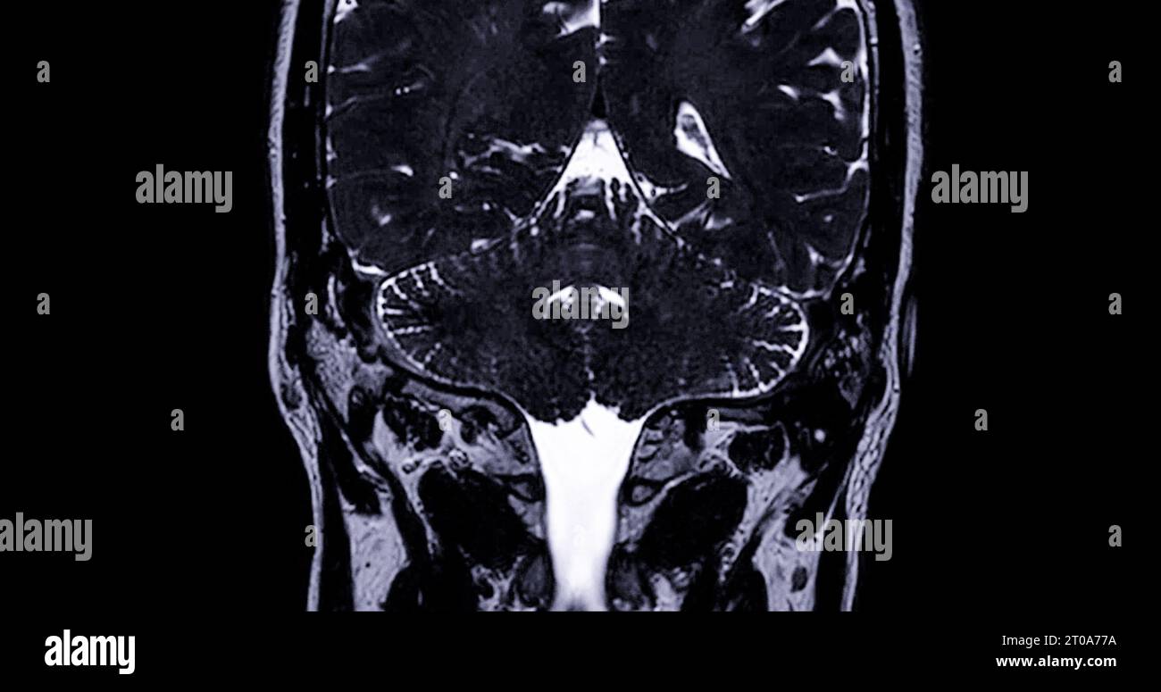 MRI scan of the internal auditory canal (IAC Stock Photo - Alamy