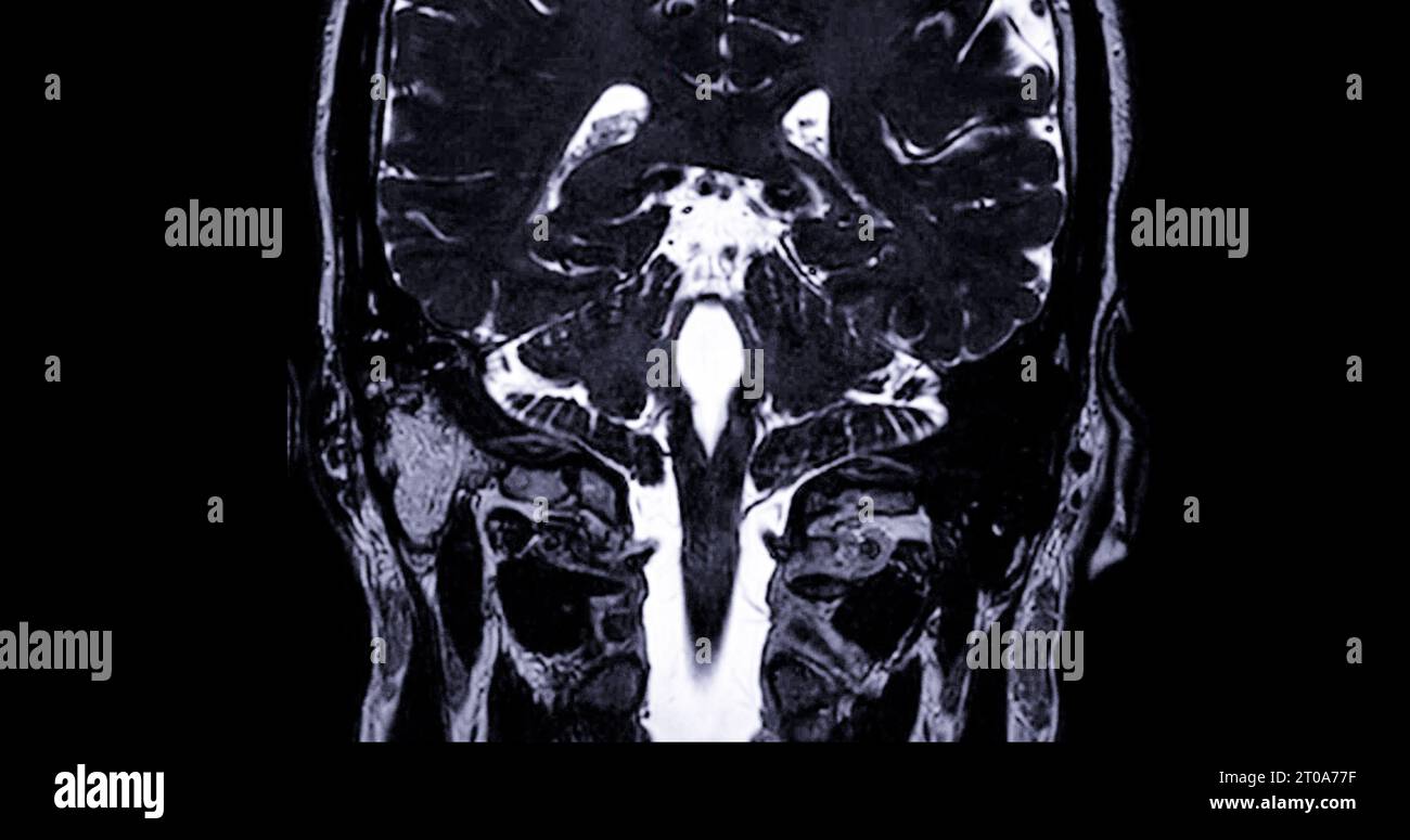 MRI scan of the internal auditory canal (IAC Stock Photo - Alamy