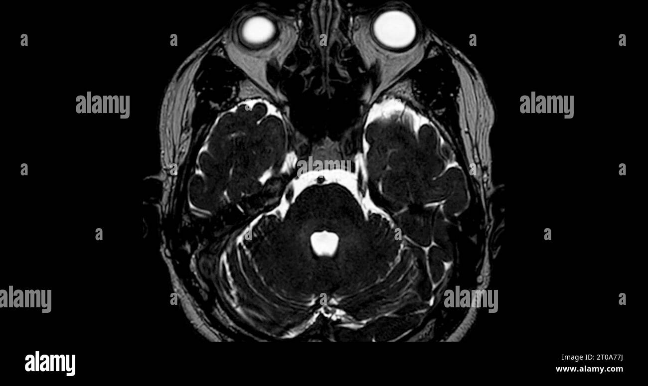 MRI scan of the internal auditory canal (IAC Stock Photo - Alamy
