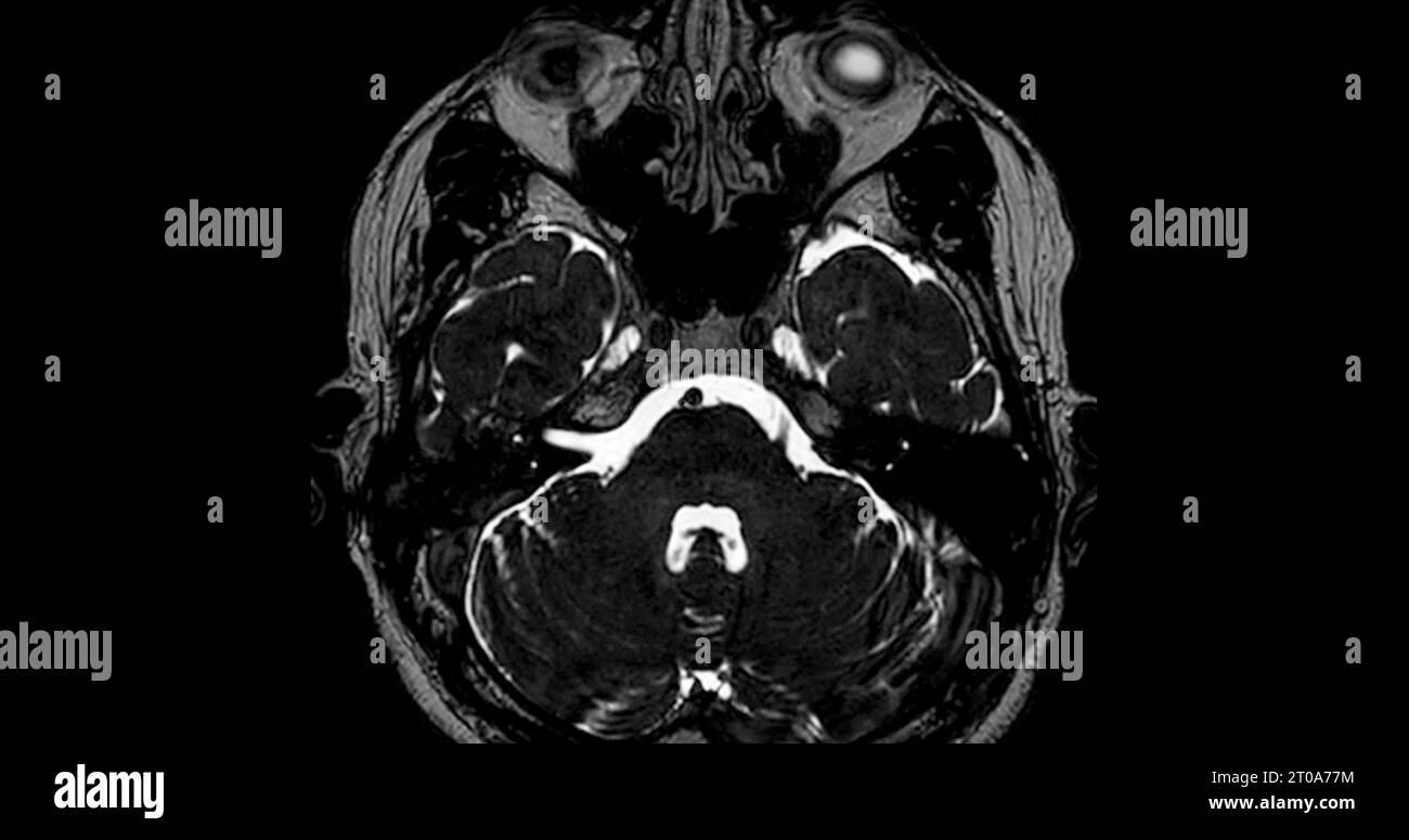 MRI scan of the internal auditory canal (IAC Stock Photo - Alamy