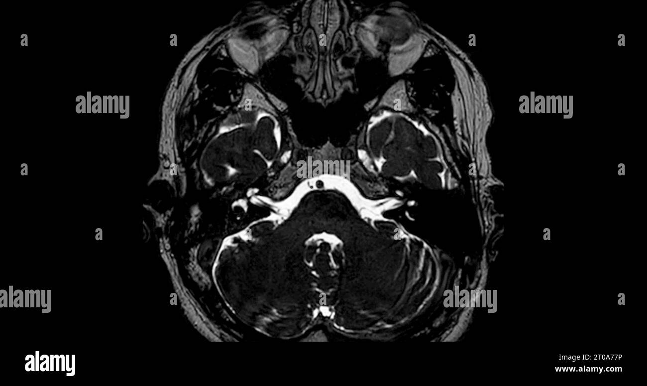 MRI scan of the internal auditory canal (IAC Stock Photo - Alamy