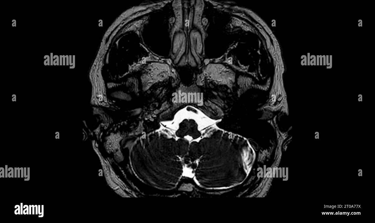 MRI scan of the internal auditory canal (IAC Stock Photo - Alamy