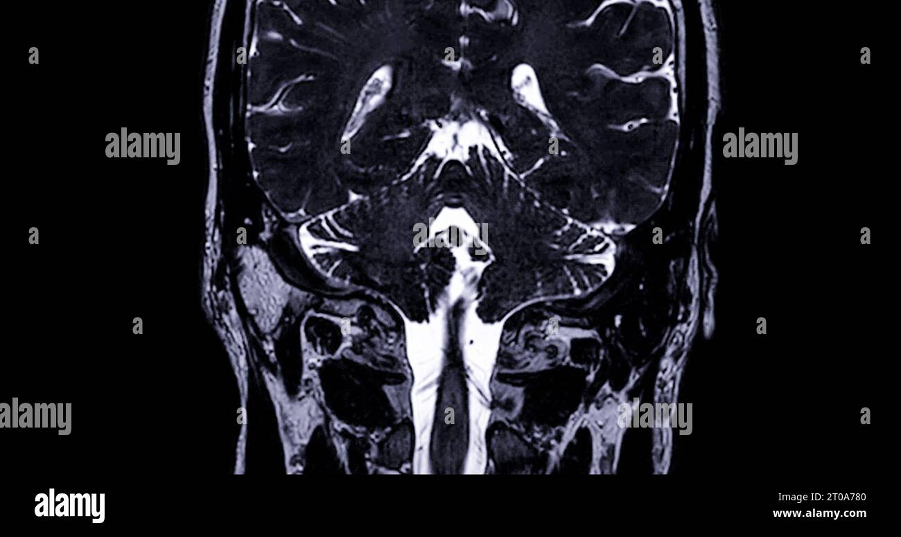 MRI scan of the internal auditory canal (IAC Stock Photo - Alamy