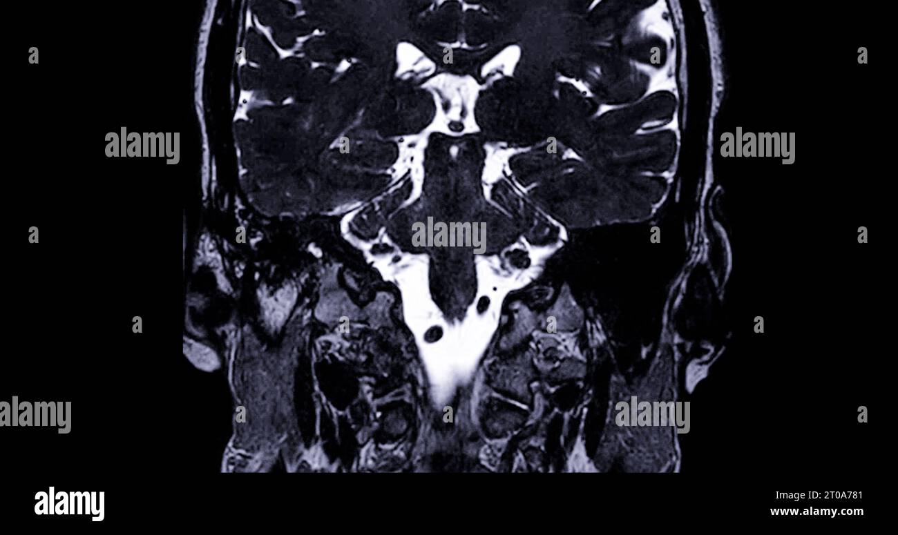 MRI scan of the internal auditory canal (IAC Stock Photo - Alamy