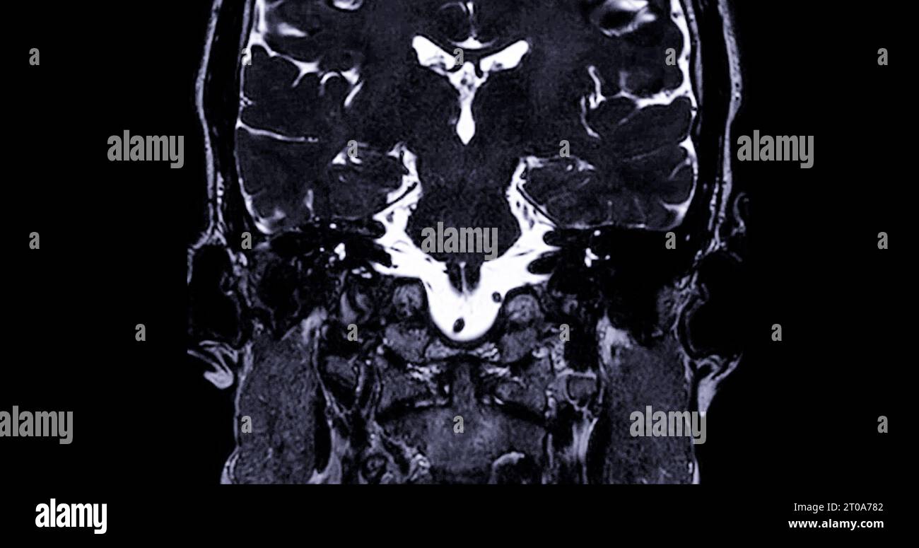 MRI scan of the internal auditory canal (IAC Stock Photo - Alamy