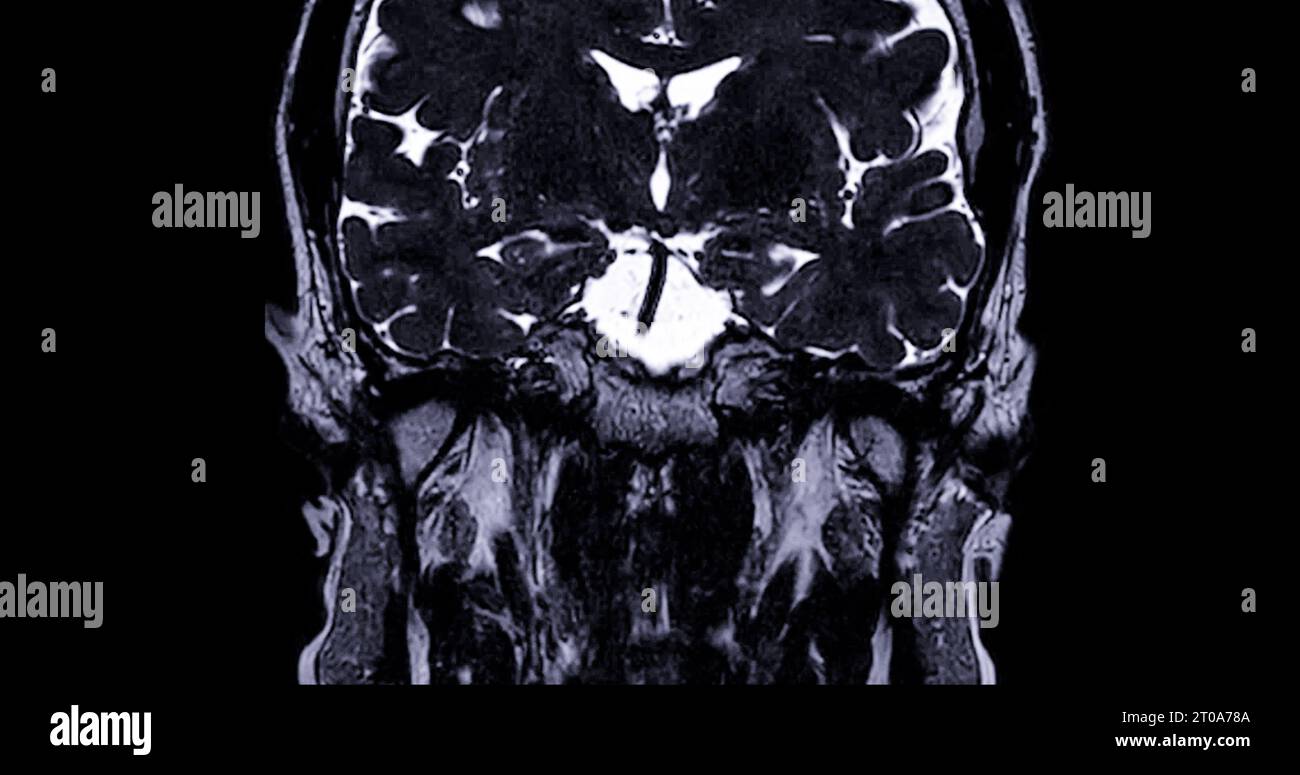 MRI scan of the internal auditory canal (IAC Stock Photo - Alamy