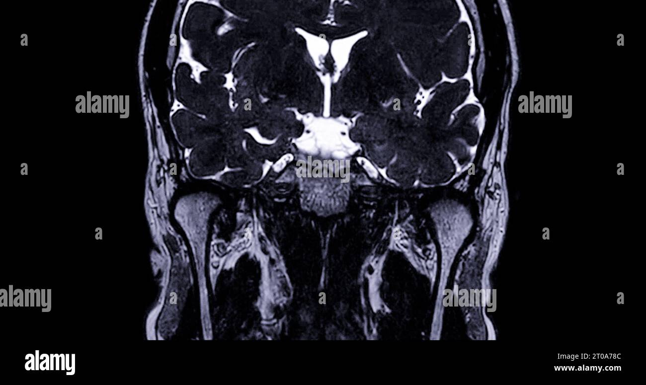 MRI scan of the internal auditory canal (IAC Stock Photo - Alamy