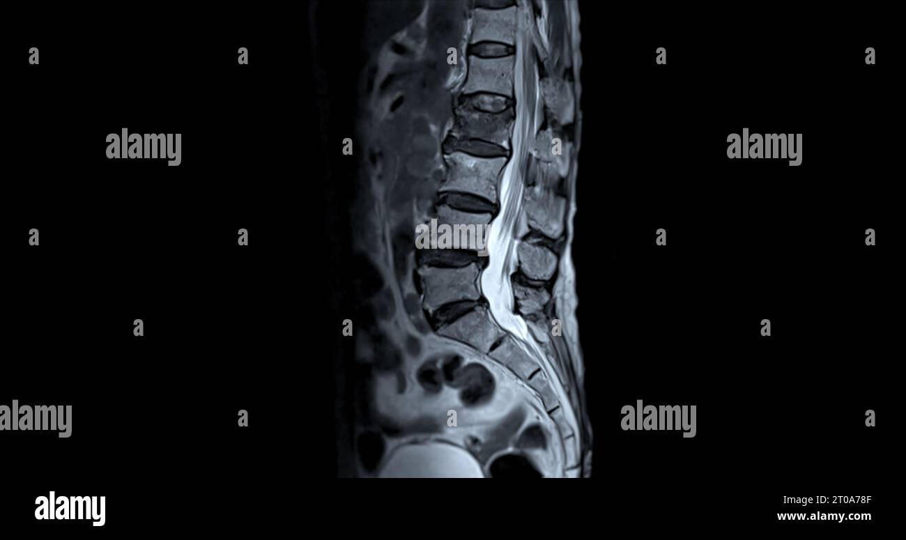 Mri Lower Back Pain