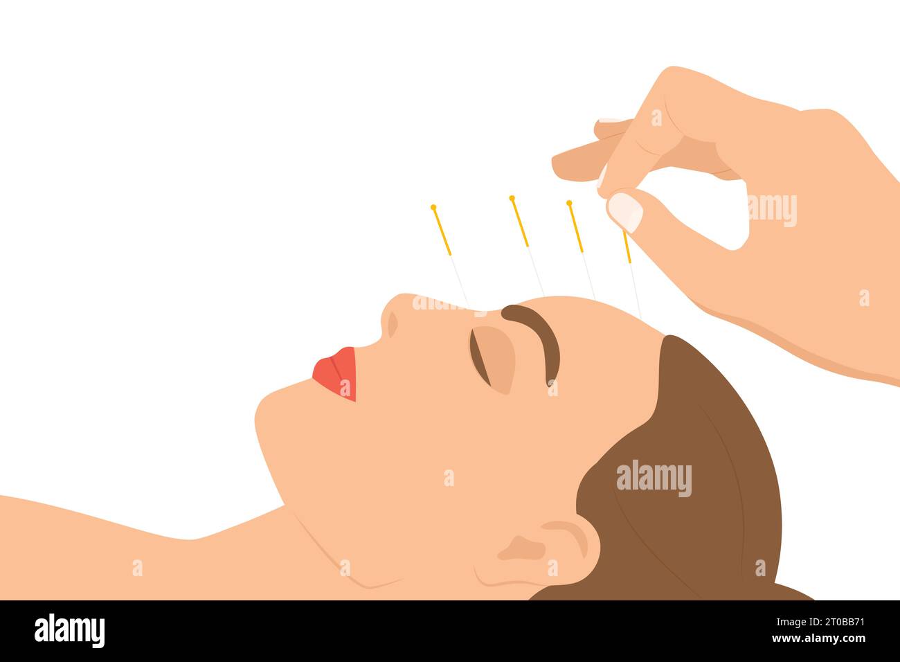 young beauty woman during procedure of acupuncture therapy- vector ...